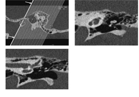 Figure 1 From Radiological Aspects Of HR CT Scan On Temporal Bone Semantic Scholar