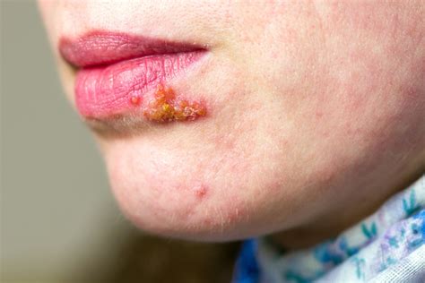 Todo Lo Que Tienes Que Saber Sobre El Herpes Causas Síntomas Y Tratamiento