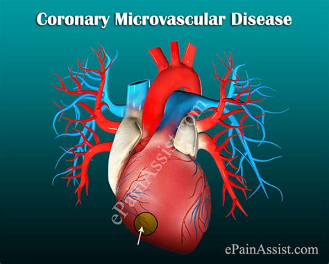 Coronary Microvascular Disease Or Small Vessel Heart Diseasecauses