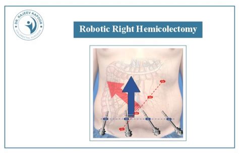 Robotic Right Hemicolectomy Minimally Surgery For Colon Cancer