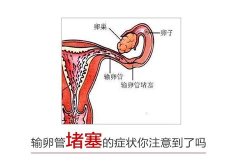 输卵管不通是什么感觉？90的女性都中招了！ 知乎
