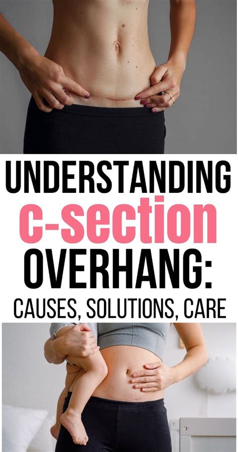 Understanding C Section Overhang Everything You Need To Know Post
