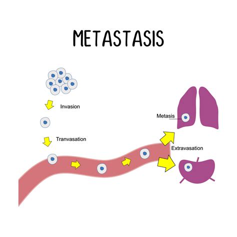 Metastasis The Spread Of Cancer Cells From The Original Tumor 23108000