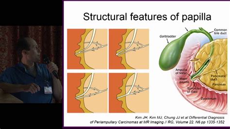 Endoscopy In The Diagnosis Of Papilla Vateri Diseases Youtube