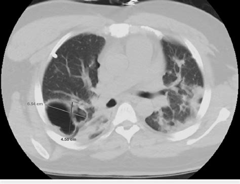 Computed Tomography Of The Chest Without Contrast Demonstrating