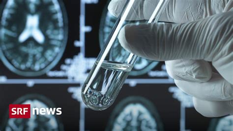 47 Millionen Kranke Weltweit Umstrittenes Alzheimer Medikament Weckt