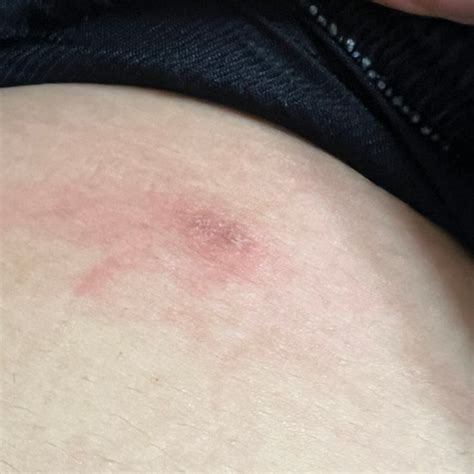 피부발진 성병 급해요ㅠㅠㅠ 지식in