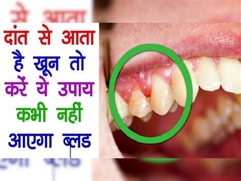 Home Remedies To Get Rid Of Gum Bleeding Hindi News मसूड़ो से बहता
