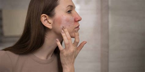 Skincare Advice For People Targeting Rednessrosacea Live Young Spa