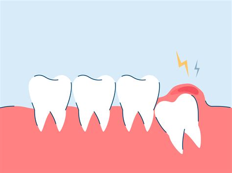Wisdom Tooth Infection Prevention Symptoms And Treatments Snow