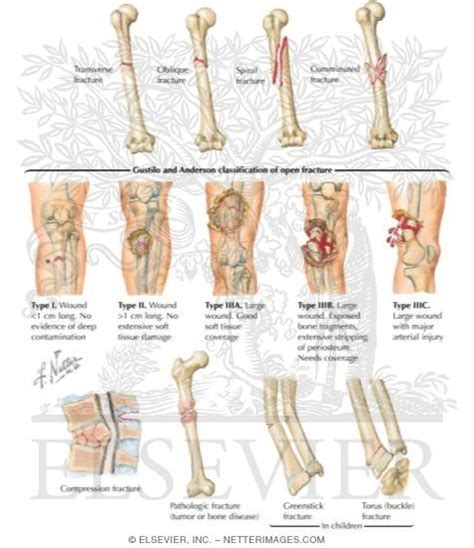 Yahoo Image Search Anatomy And Physiology Open Fracture Pa C