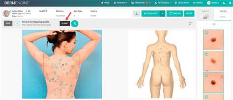 How Do I Map Lesions To The Body Map
