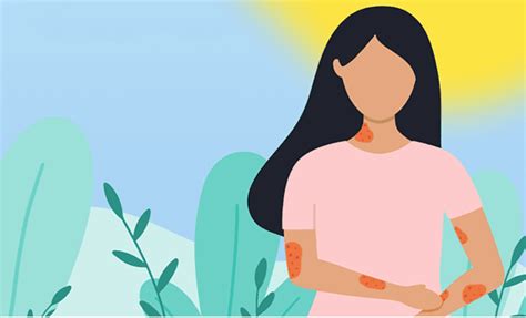 8 Simple Tips To Prevent Psoriasis Flare Ups Alternative Approach To