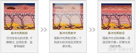 为什么去美容院做光子嫩肤会“毁容”？ 知乎