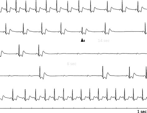 Vagally Mediated Atrioventricular Block Pathophysiology And Diagnosis Heart