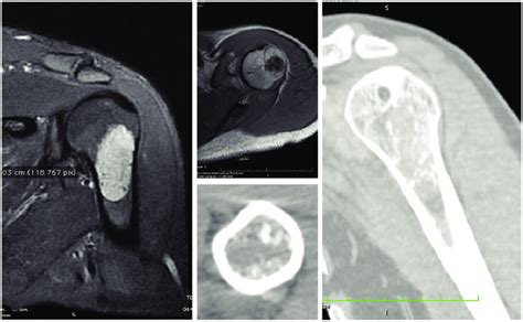 Chondrosarcoma Mri