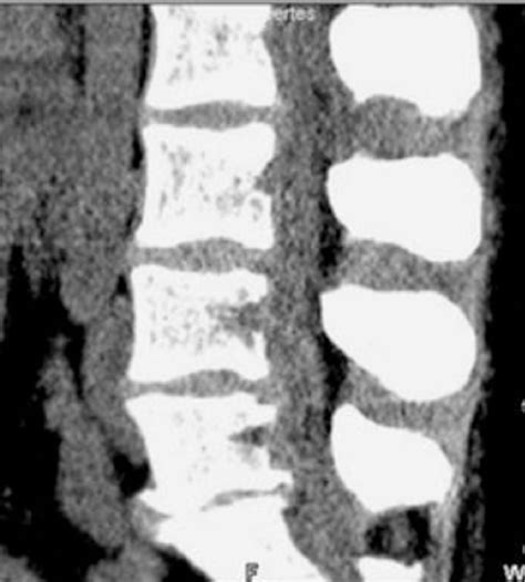 Figure 2 From Role Of Mr In The Diagnosis Of Spinal Epidural Abscess