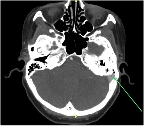 Genioglossus Ct
