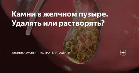 Камни в желчном пузыре Удалять или растворять Клиника ЭКСПЕРТ