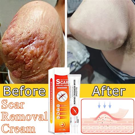 Creme De Remoção De Cicatriz Remover Acne Spots Tratamento Estrias