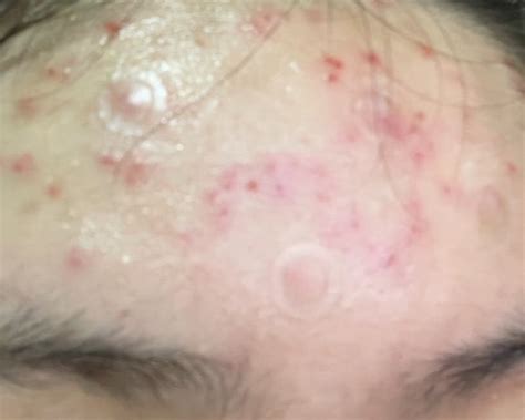 피부과 여드름 압출했는데 빨간끼는 언제 내려가나요ㅠ 지식in