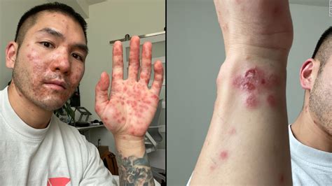 Gay Men Are Lining Up As Early As 2 Am For Monkeypox Vaccines Many