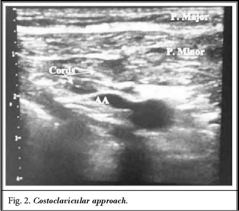 Figure 2 From Ultrasound Guided Retroclavicular Approach Versus Costoclavicular Approach Of