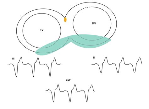 Ecg Analysis Of Pre Excitation Wpw Without Algorithms Ep Made Easy