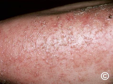 Asteatotic Eczema Eczema Craquele