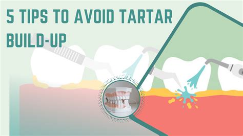 5 Tips To Avoid Tartar Build Up Creative Dental Clinic