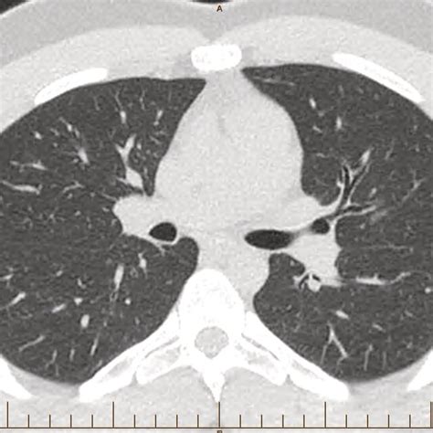 High‐resolution Computed Tomography Hrct Scan Of The Patient At Two