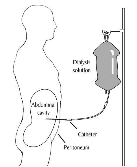 Peritoneal Dialysis Diagram