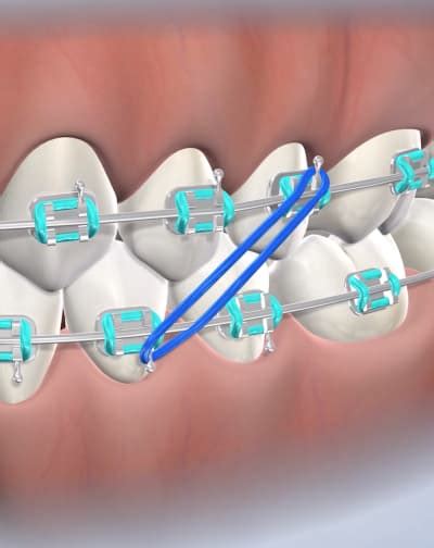 Bite Correction Services In Tx Full Smile Orthodontics