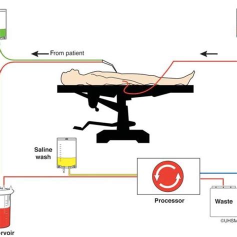 Intraoperative Cell Salvage Reproduced With Permission From Uk Cell