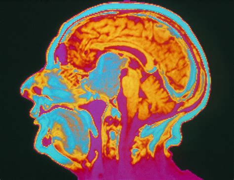 Coloured Mri Brain Scan Of A Pituitary Tumour Photograph By Mehau Kulyk