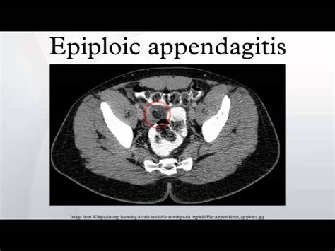 Epiploic Appendagitis Image Radiopaediaorg Ct Imaging Findings Of