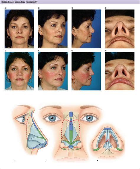 Secondary Rhinoplasty Plastic Surgery Key