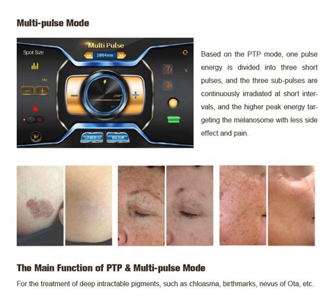 Laser Tattoo Removal Machine Picolite Canta Esthetic