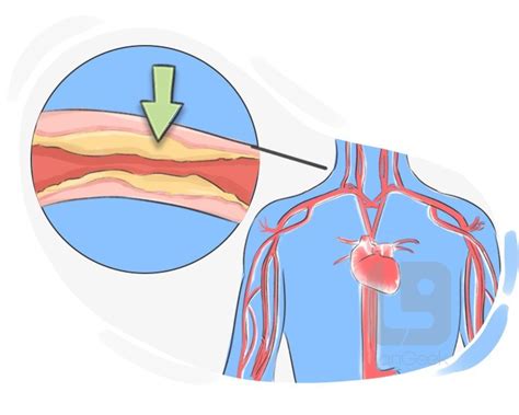 Definition And Meaning Of Cholesterol Langeek