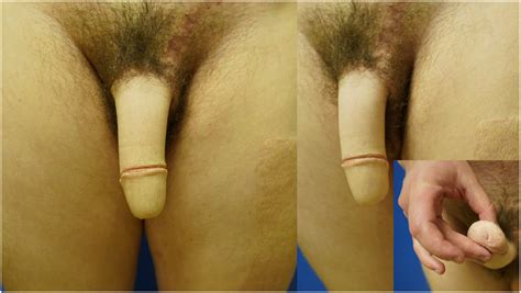 Options And Indications In Gender Affirming Phalloplasty Clinics In