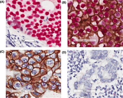 Er And Her2 Double Staining Er In The Nucleus Is Detected As A Red Download Scientific Diagram
