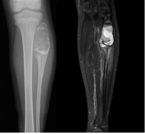 Aneurysmal Bone Cyst Mri