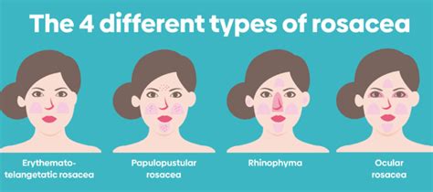 Rosacea • Precision Dermatology Pa Rosacea Treatment In Kerrville Tx