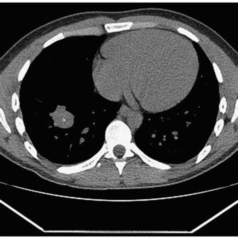 T Scan Of Chest Showing A 33 Cm Lobulated Irregular Mass Located