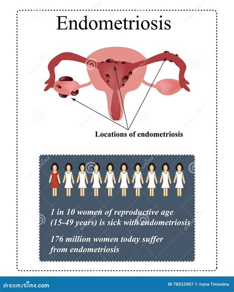 Endometriosis Vector Illustration On Background Stock Vector
