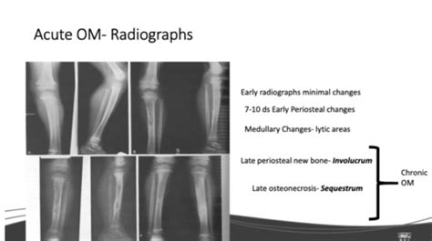 Acute And Chronic Osteomyelitis Flashcards Quizlet