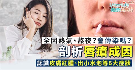 【唇瘡成因】因熱氣、熬夜？會傳染？皮膚紅腫、出小水泡等5大症狀