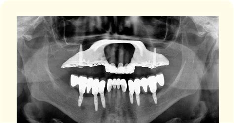 Panoramic Radiograph With Rpd At 1 Year Recall Download Scientific