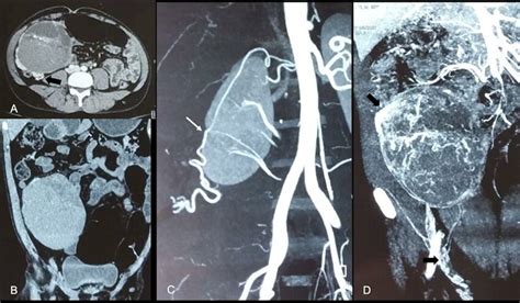 Contrast Enhanced Ct Axial A Coronal B Arterial Phase Coronal Mip