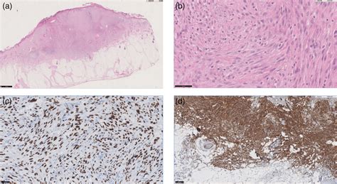Histopathology Of Pleomorphic Dermal Sarcoma A And B Hematoxylin And Download Scientific